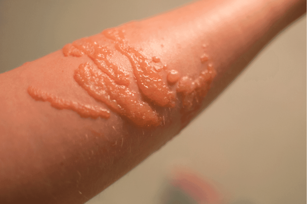 Disinfestazione Ragni: Eliminazione Professionale